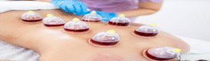 Traditional Medicine : Wet vs Dry Cupping Therapy - MY Sports Injury ...