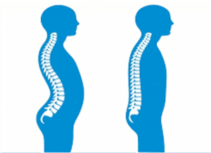 Lumbar Lordosis: Why Your Spine’s Curve—and Posture—Matter When Weight ...
